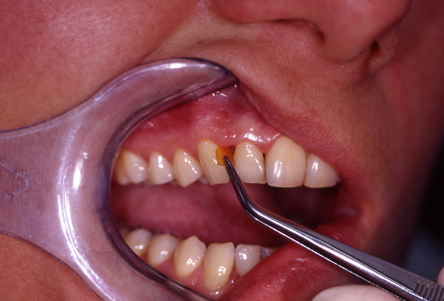 Periochip Behandlung | Zahnarztpraxis