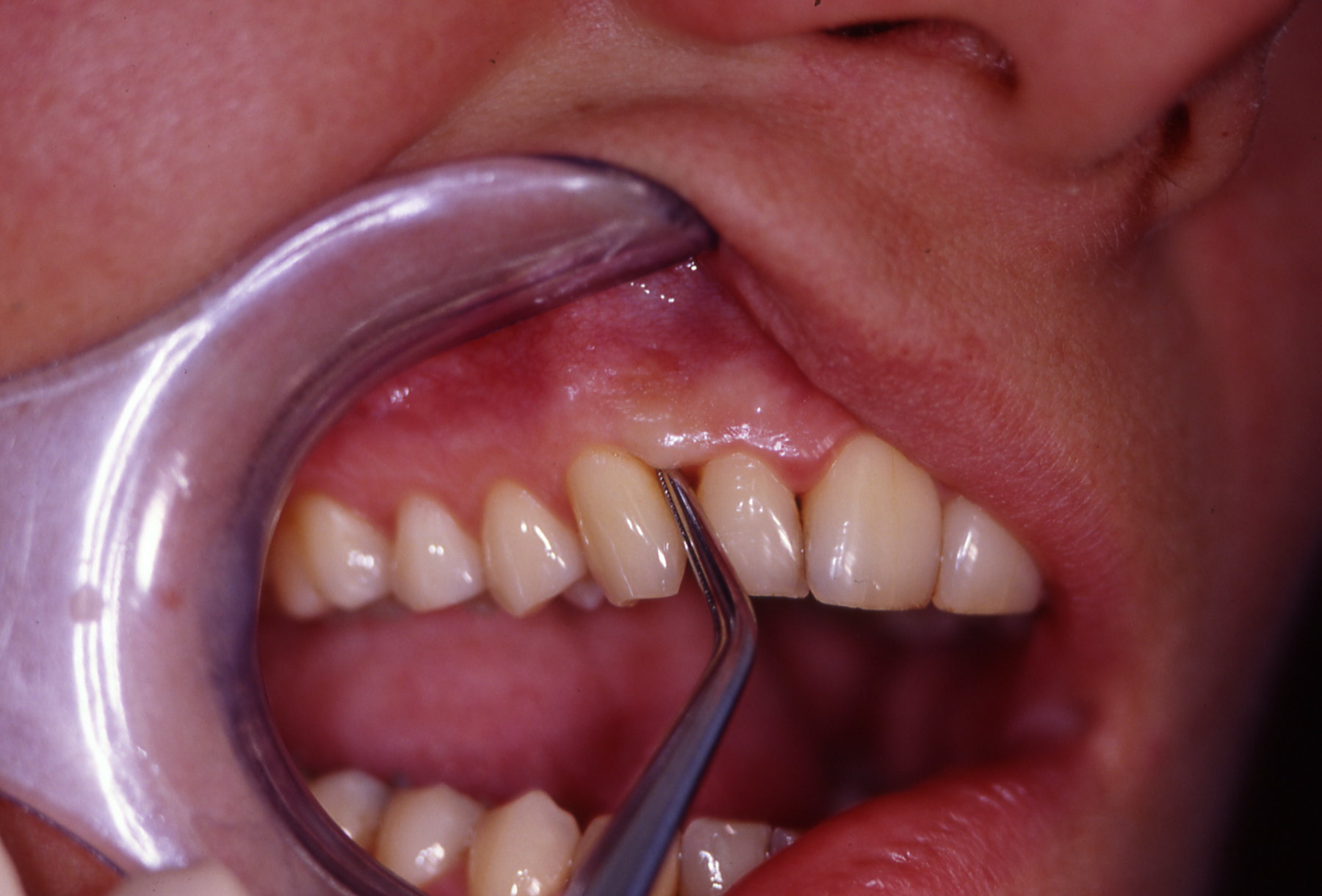 Periochip Behandlung | Zahnarztpraxis